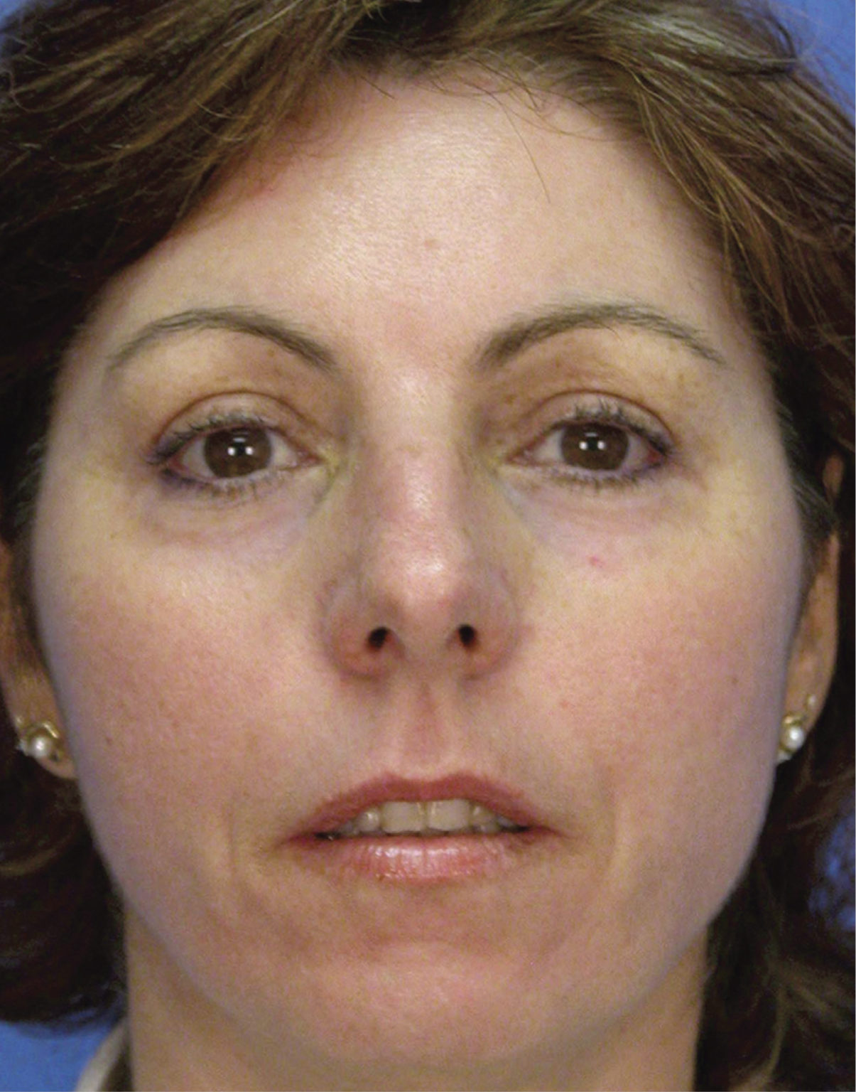 MicroLaserPeel® - Sciton