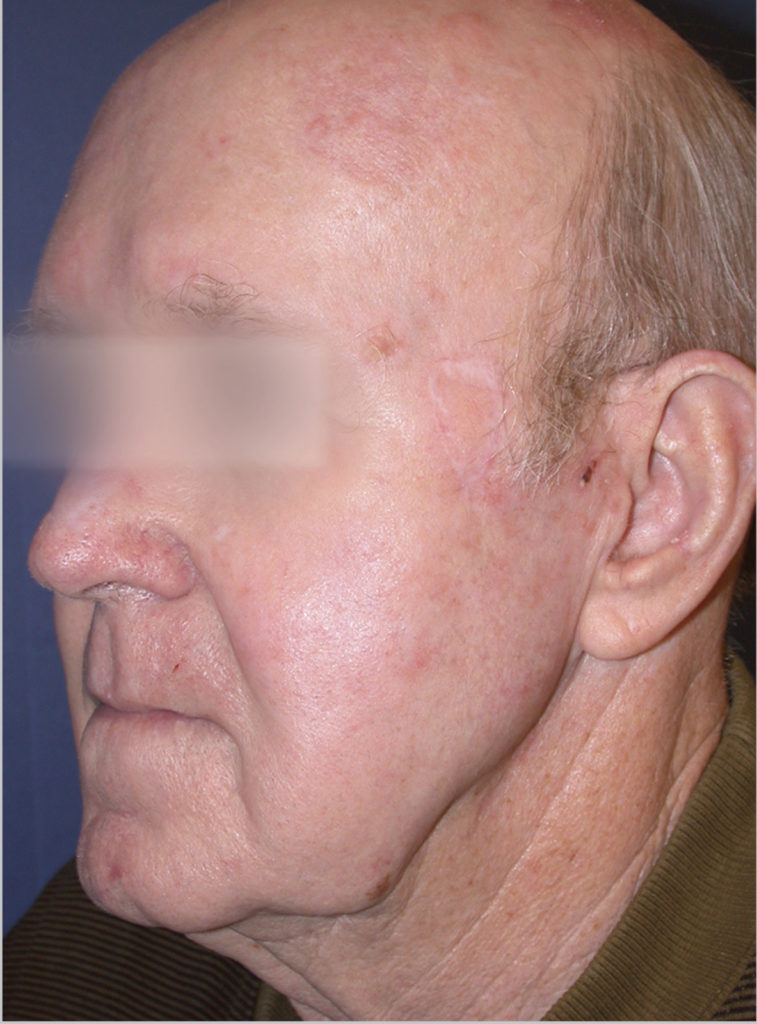 Profractional® Laser Resurfacing By Sciton