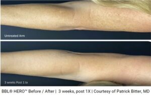 Sciton's BroadBand Light (BBL®) Technology Is Revolutionizing The ...