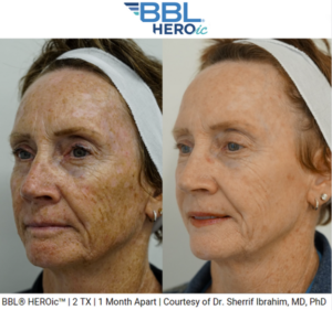 The Future of Skin Health is Now: Meet the World's Smartest Pulsed ...