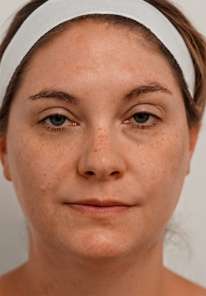 Meet the mJOULE® by Sciton