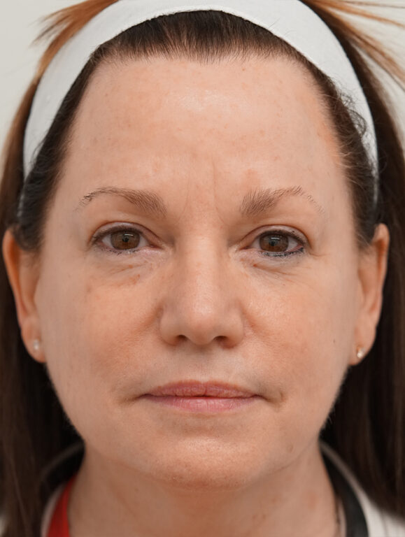 BBL® HEROic™️ - Sciton