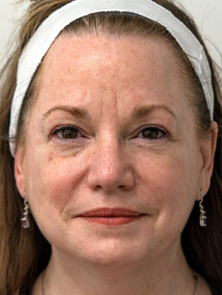 BBL® HEROic™️ - Sciton