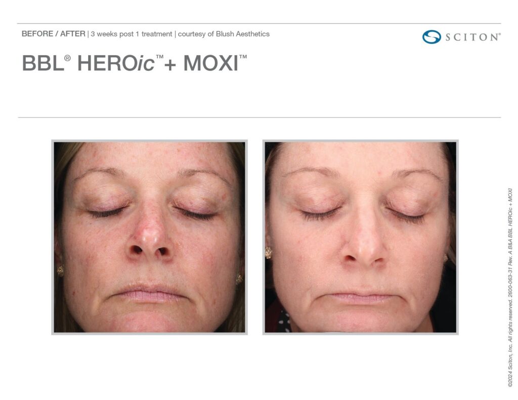 You've Been Matched! Why BBL® HEROic™ is the Perfect Fit for Your ...