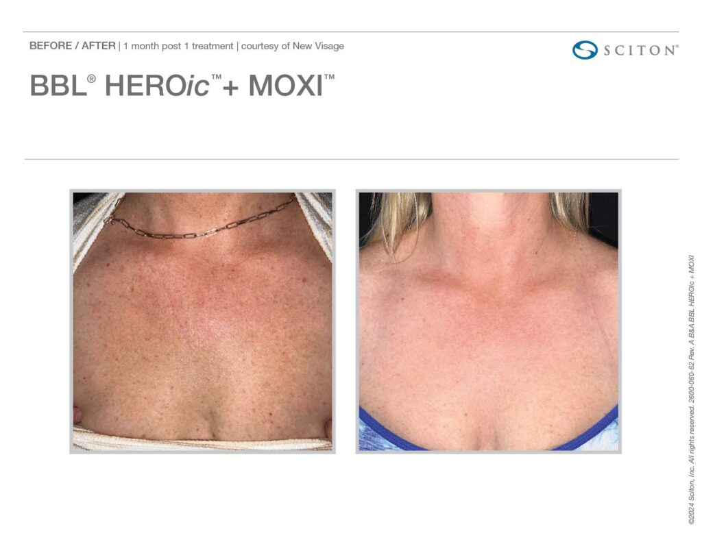 You've Been Matched! Why BBL® HEROic™ is the Perfect Fit for Your Practice - Sciton