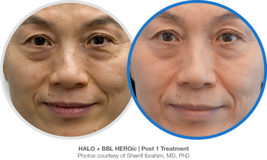 You've Been Matched! Why BBL® HEROic™ is the Perfect Fit for Your ...