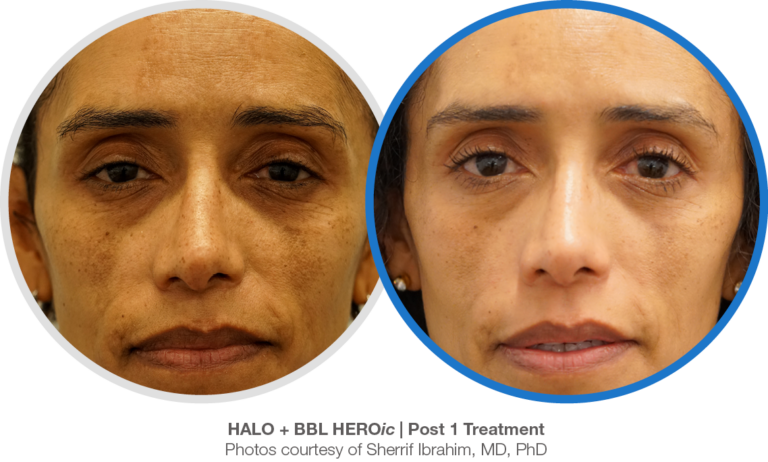 You've Been Matched! Why BBL® HEROic™ is the Perfect Fit for Your ...