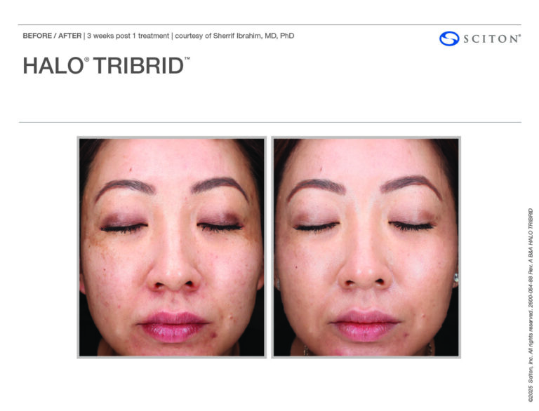 HALO® TRIBRID™ - Sciton